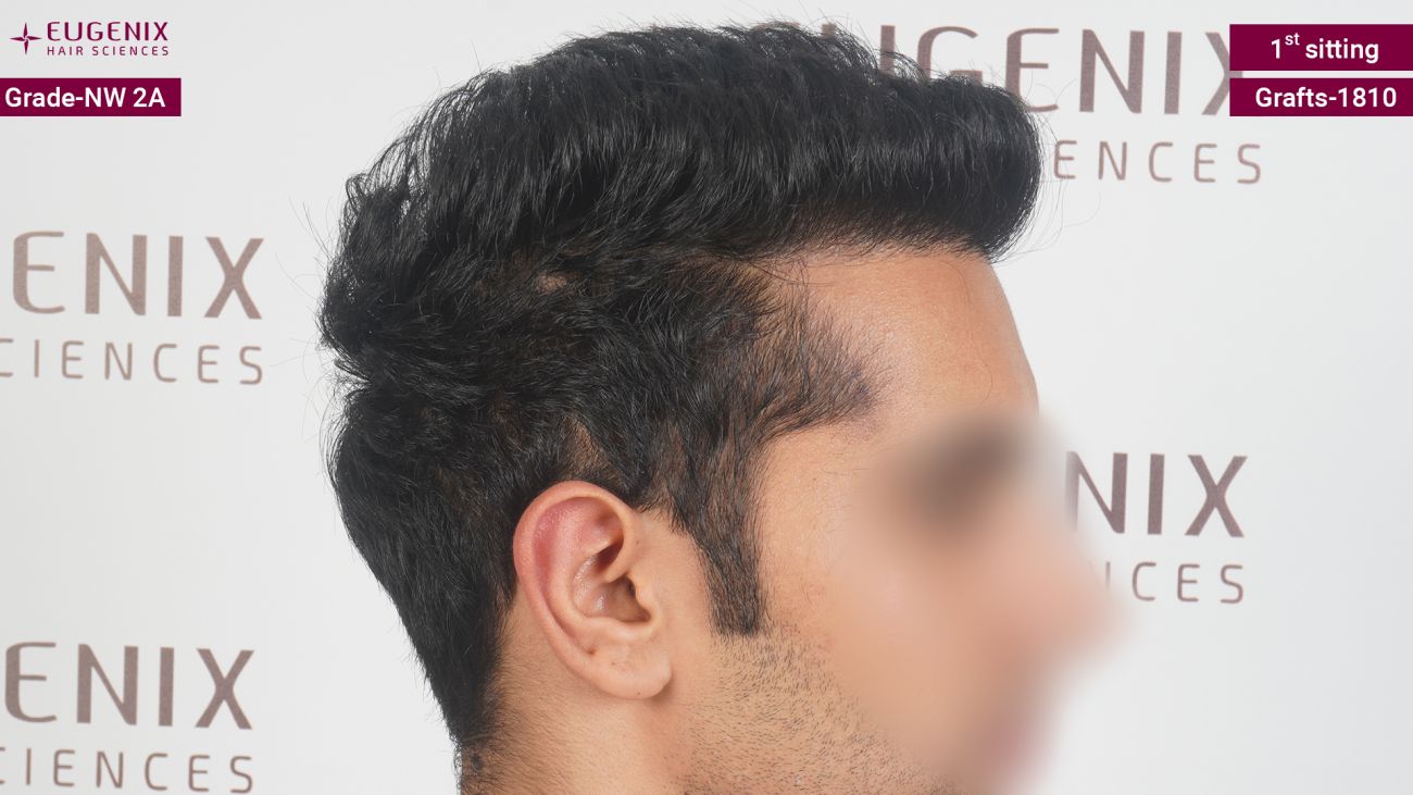 EUGENIX HAIR SCIENCES | NW2 | TRANSFORMATION