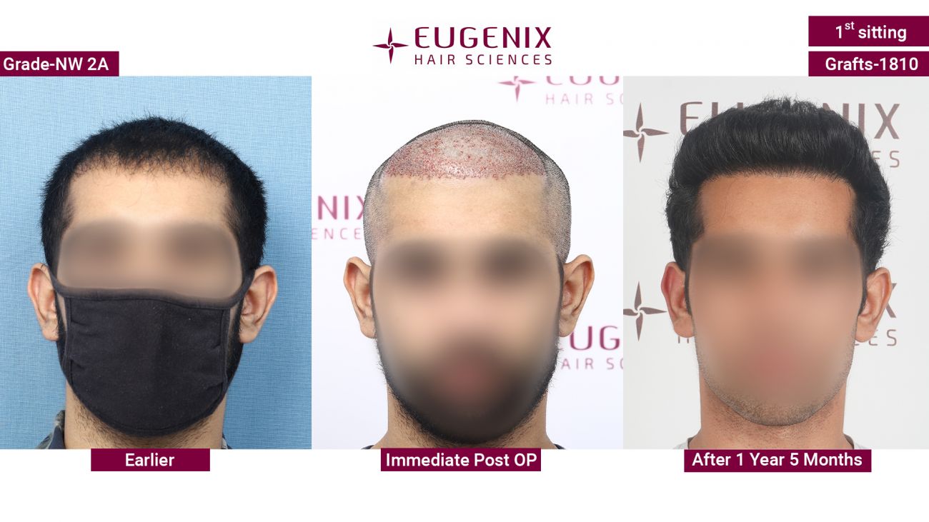 EUGENIX HAIR SCIENCES | NW2 | TRANSFORMATION