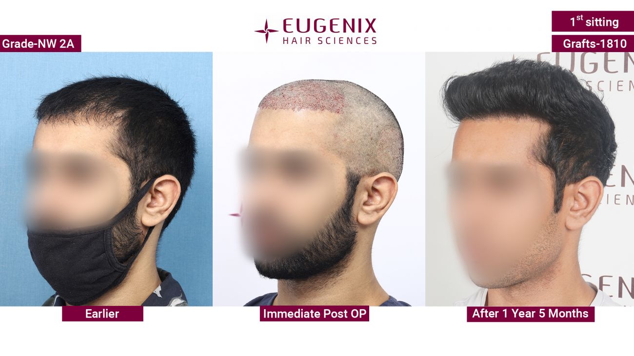 EUGENIX HAIR SCIENCES | NW2 | TRANSFORMATION