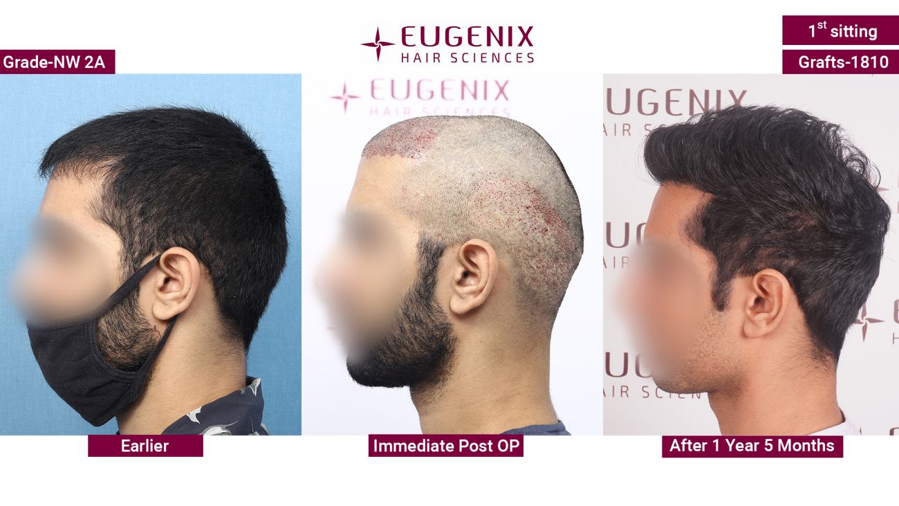 EUGENIX HAIR SCIENCES | NW2 | TRANSFORMATION