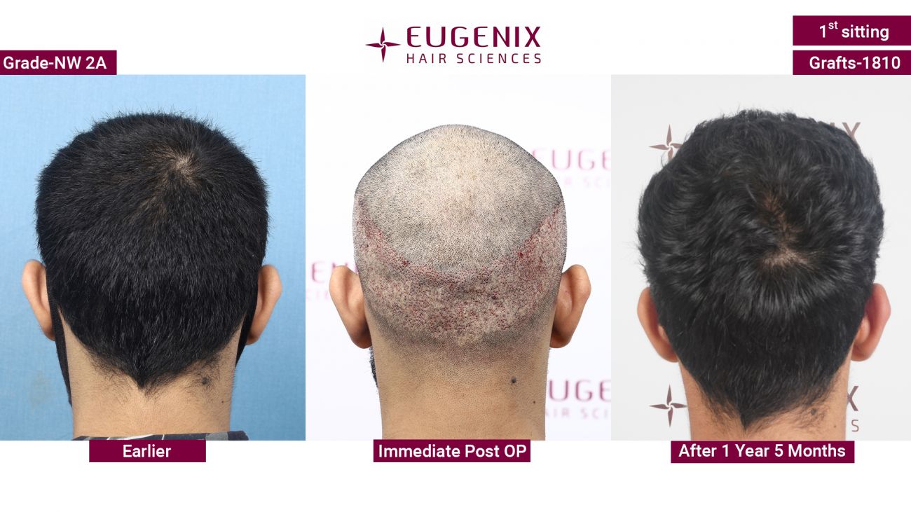 EUGENIX HAIR SCIENCES | NW2 | TRANSFORMATION
