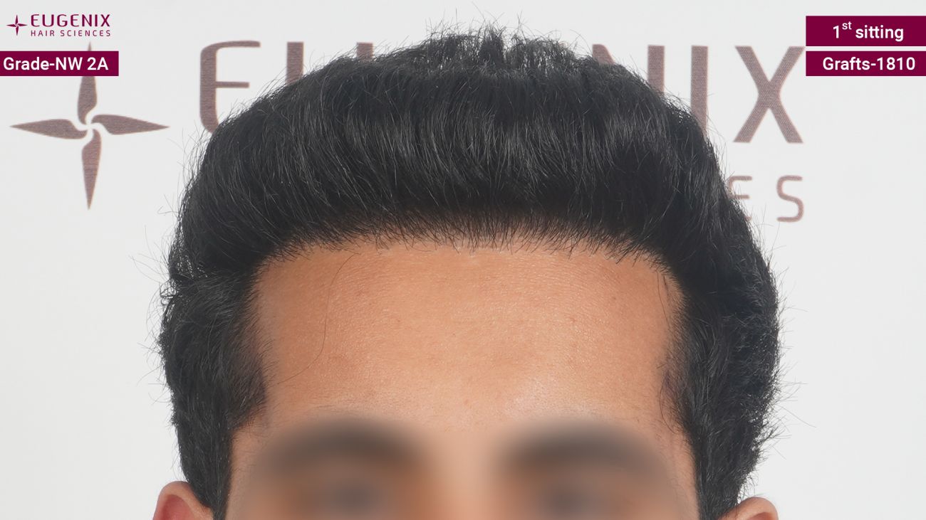 EUGENIX HAIR SCIENCES | NW2 | TRANSFORMATION