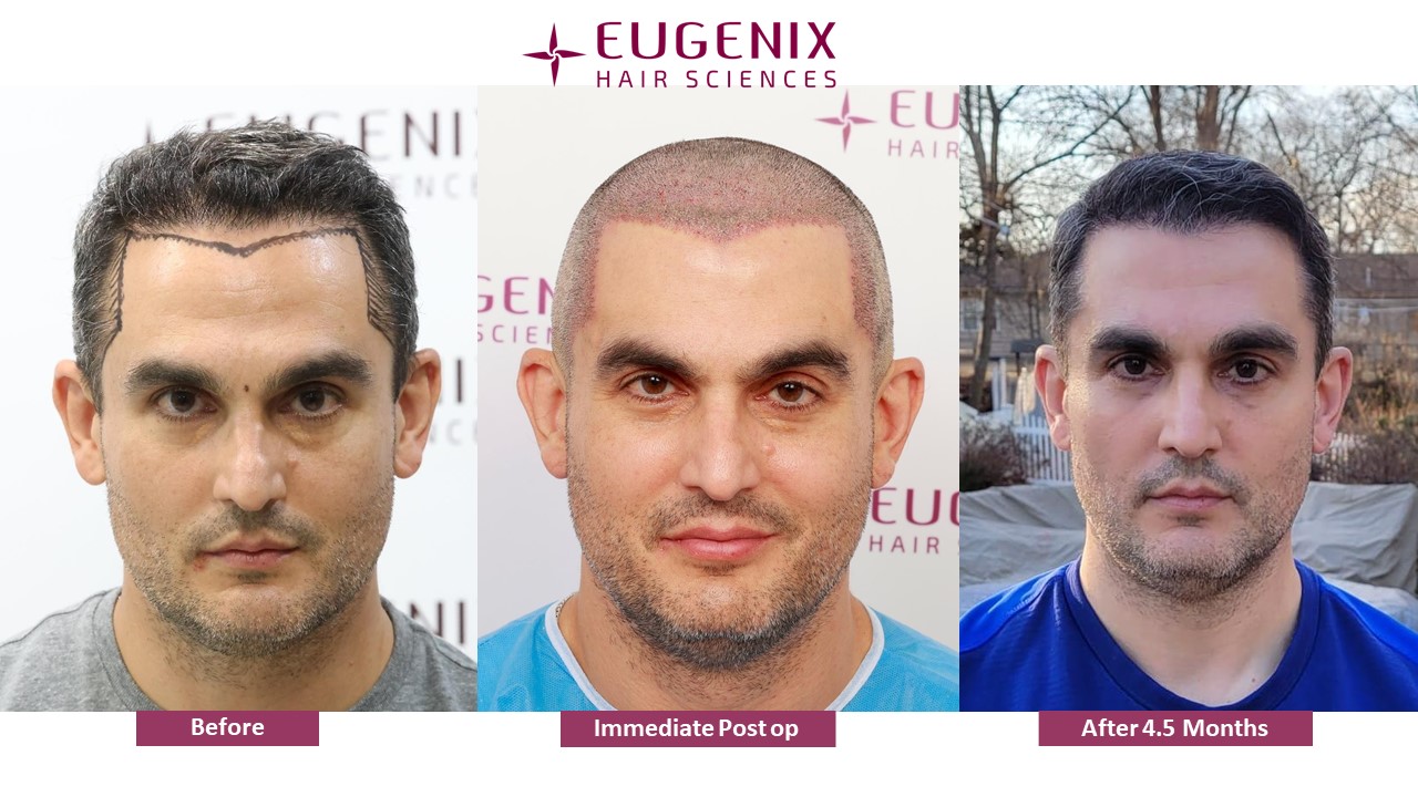 EUGENIX HAIR SCIENCES | NW3V | EPIC TRANSFORMATION