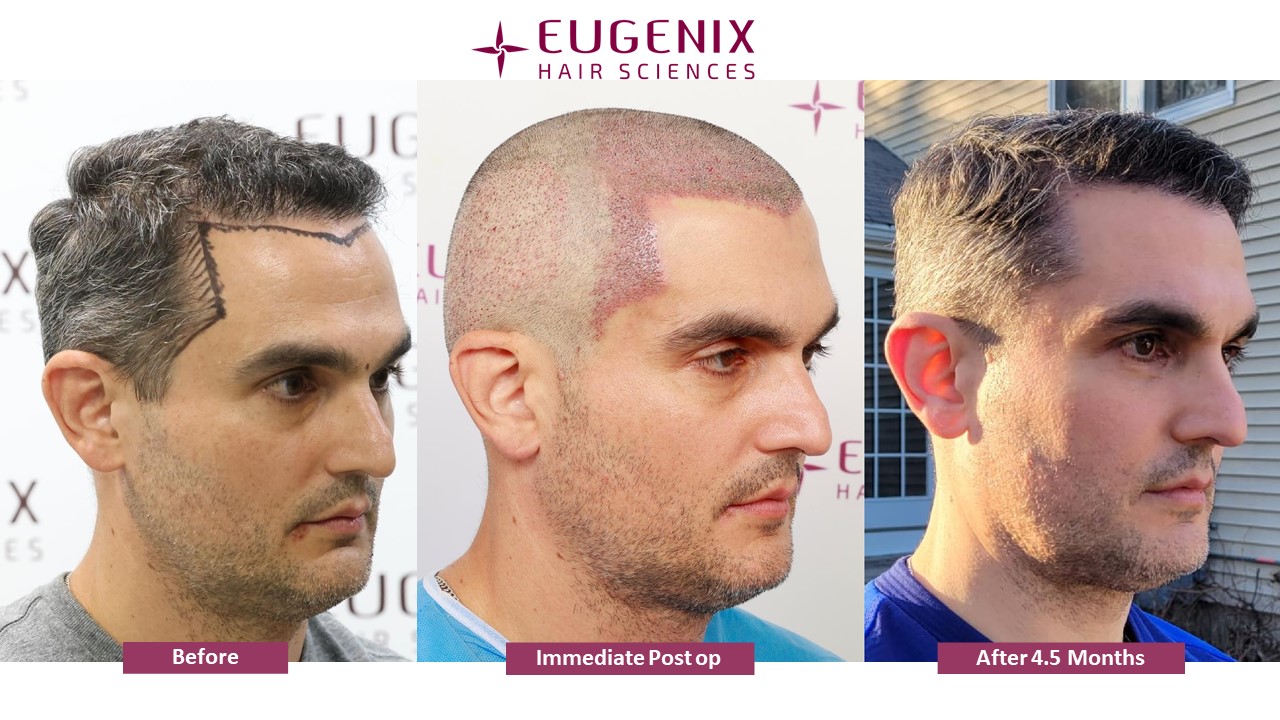 EUGENIX HAIR SCIENCES | NW3V | EPIC TRANSFORMATION