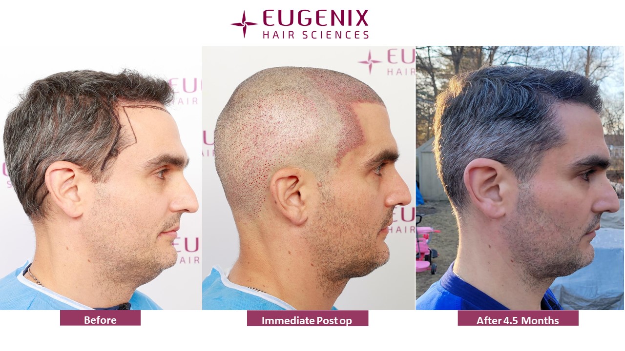 EUGENIX HAIR SCIENCES | NW3V | EPIC TRANSFORMATION