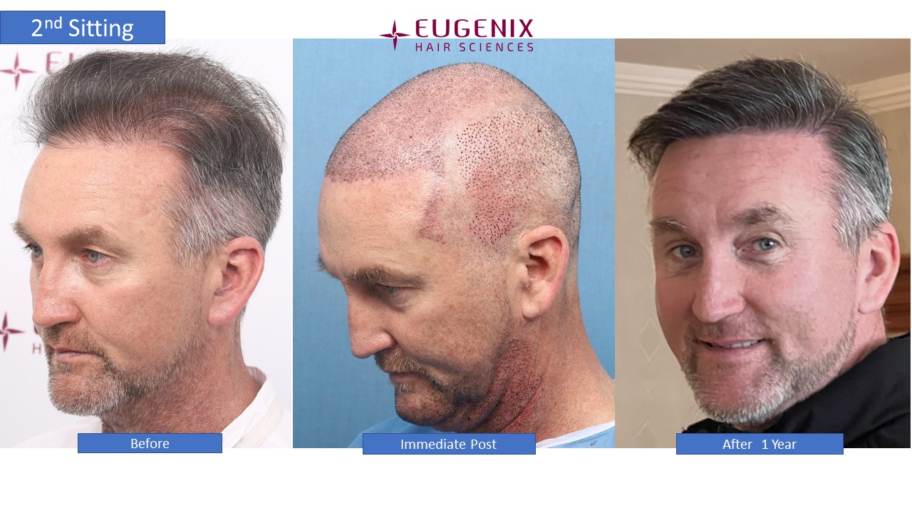 EUGENIX HAIR SCIENCES | NW7 | FULL COVERAGE Bellicapelli Forum