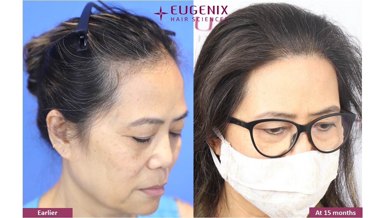 DR. PRADEEP SETHI| EUGENIX | 1455 GRAFTS | 15 MONTHS POST-OP | FEMALE ...