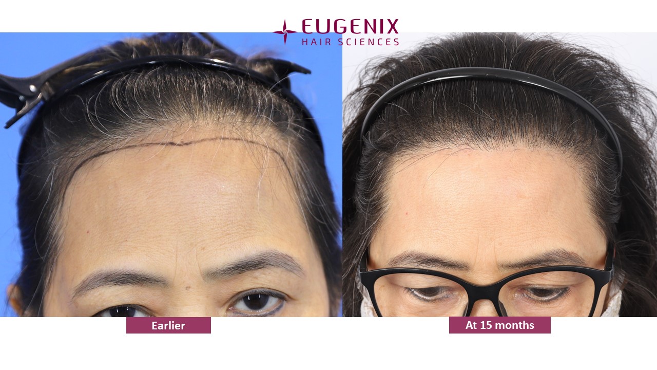DR. PRADEEP SETHI| EUGENIX | 1455 GRAFTS | 15 MONTHS POST-OP | FEMALE ...
