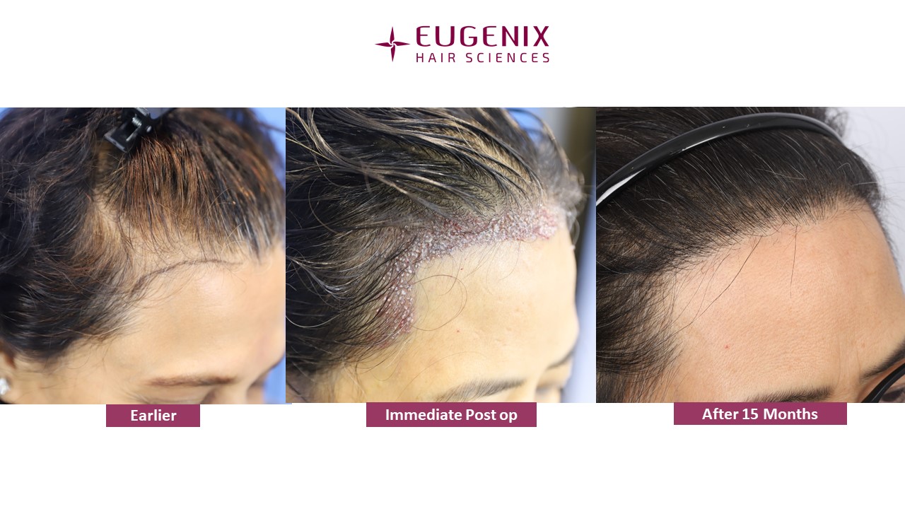 DR. PRADEEP SETHI| EUGENIX | 1455 GRAFTS | 15 MONTHS POST-OP | FEMALE ...