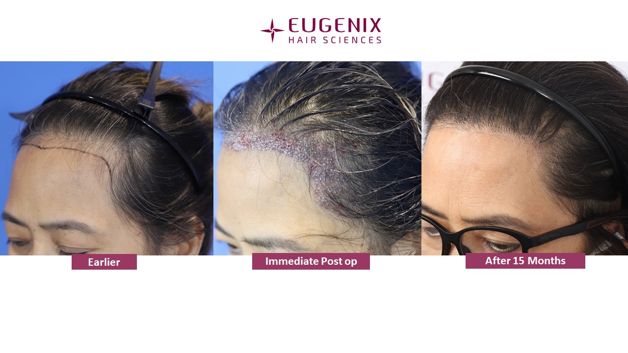DR. PRADEEP SETHI| EUGENIX | 1455 GRAFTS | 15 MONTHS POST-OP | FEMALE ...