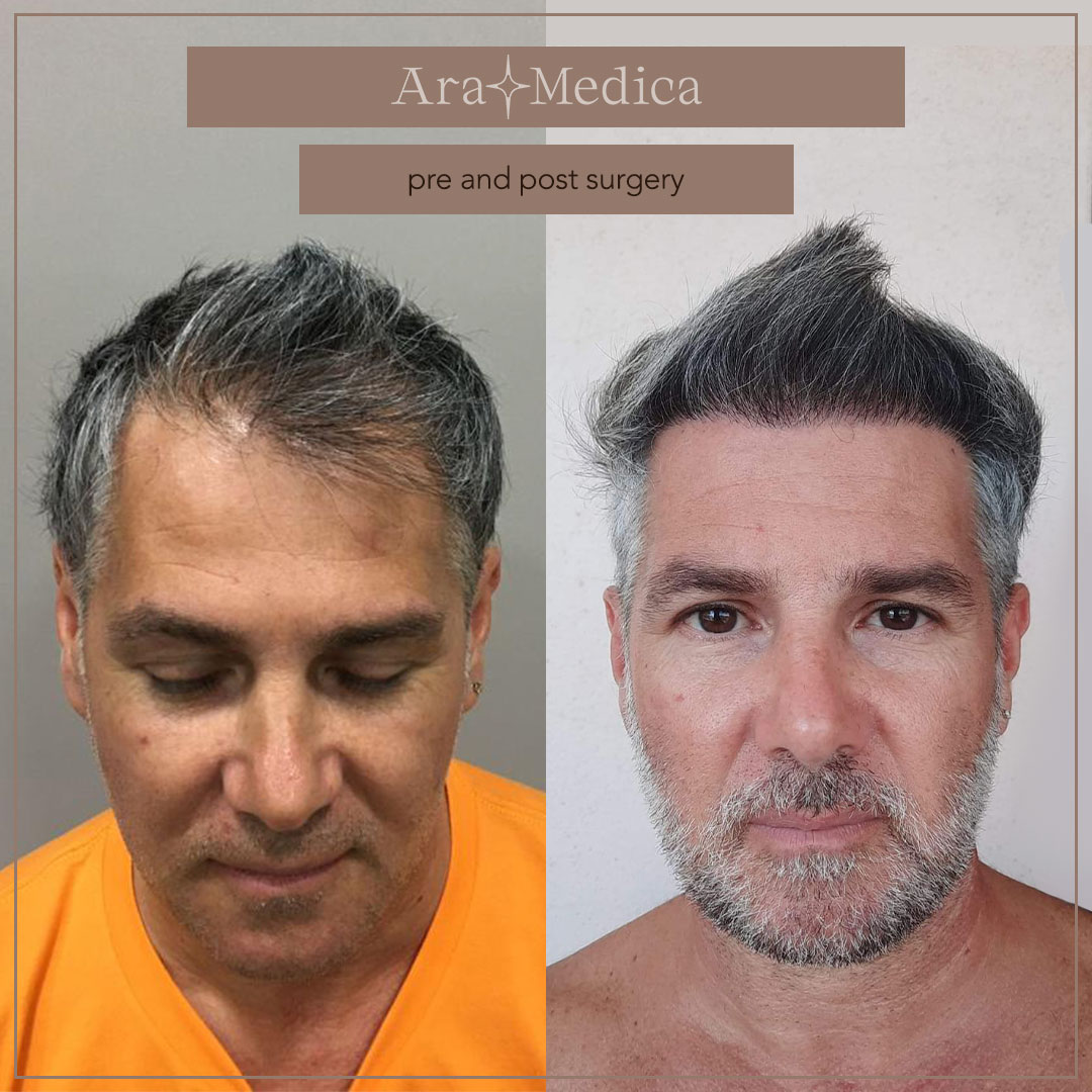 ARAMEDICA - 3500 GRAFTS FUE VERTEX + FRONT Bellicapelli Forum