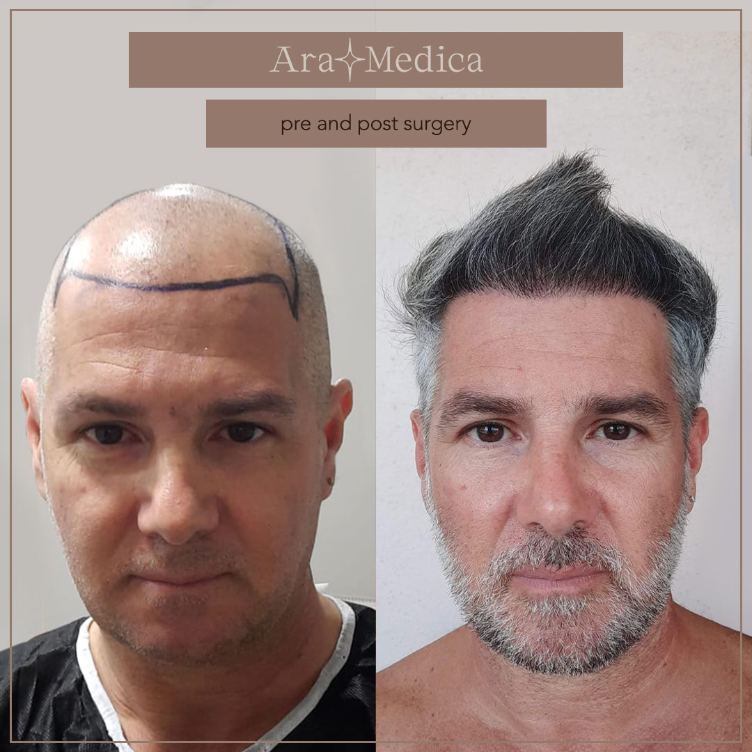 Caso Clinica Aramedica- 3500 uf fue vertex + front