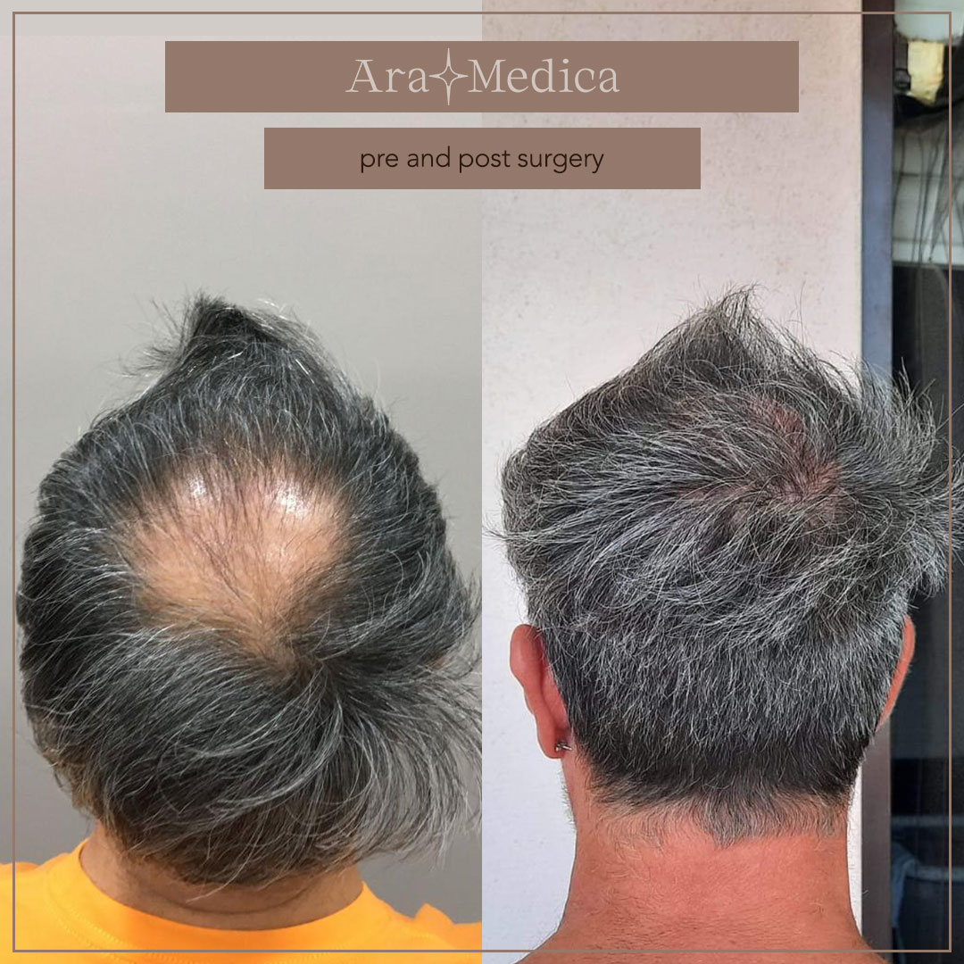 ARAMEDICA - 3500 GRAFTS FUE VERTEX + FRONT Bellicapelli Forum